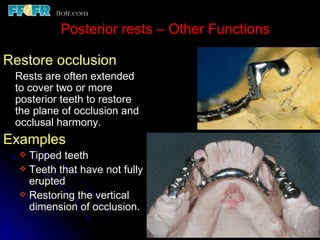 3.partial denture rests | PPT