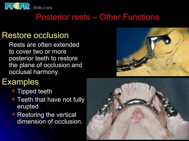 3.partial denture rests | PPT