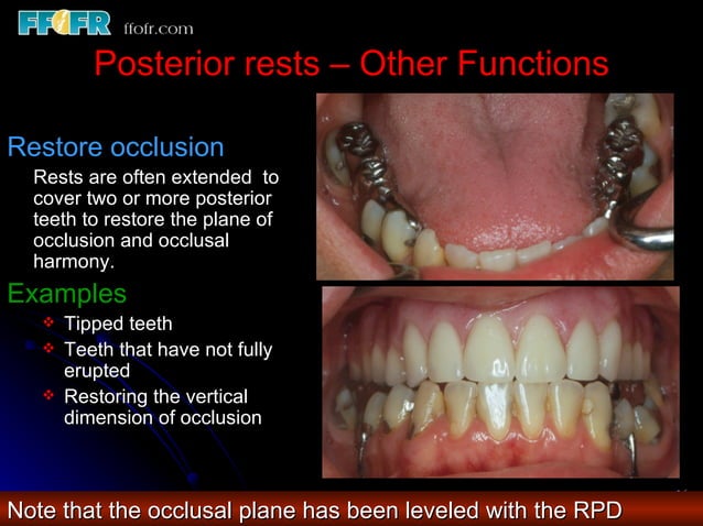 3.partial denture rests | PPT