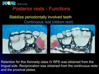 3.partial denture rests | PPT