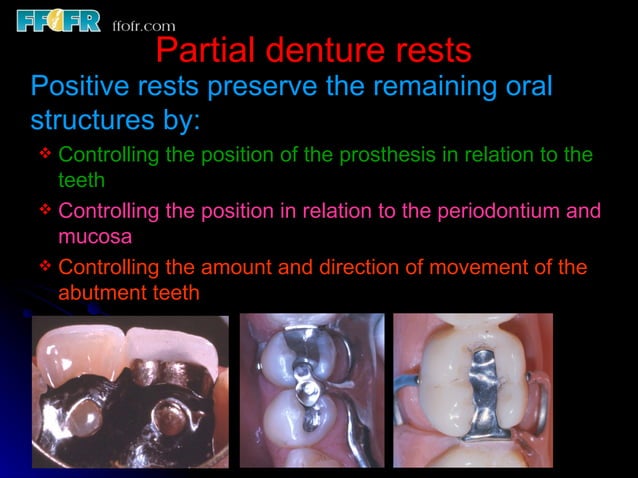 3.partial denture rests | PPT