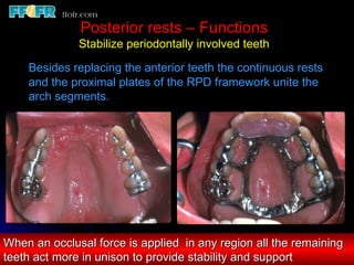 3.partial denture rests | PPT