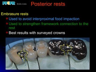 3.partial denture rests | PPT