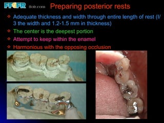 3.partial denture rests | PPT