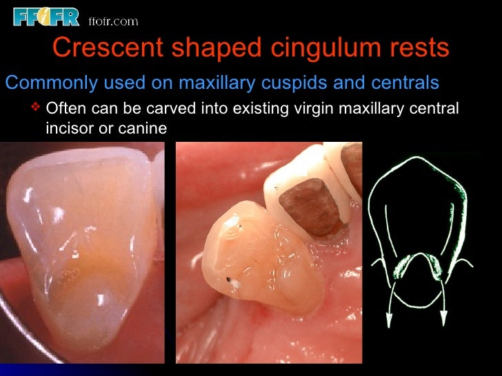 3.partial denture rests