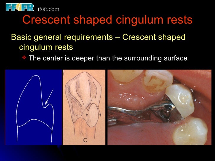 3.partial denture rests