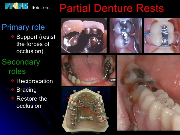 3.partial denture rests