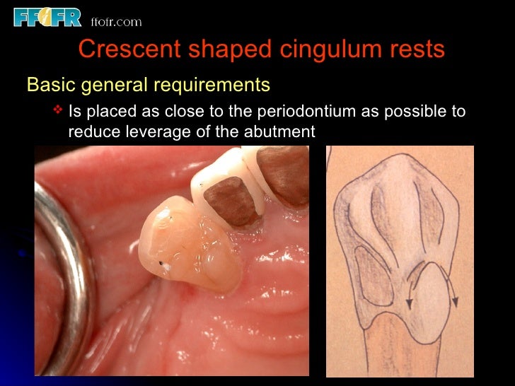 3.partial denture rests