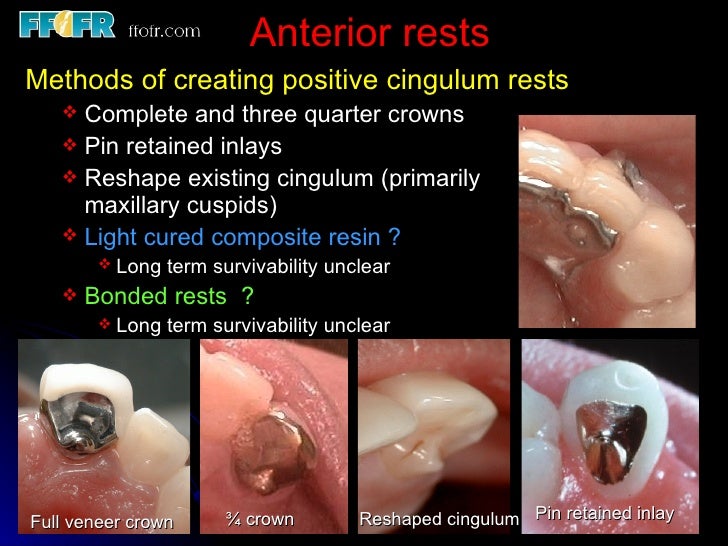 3 partial Denture Rests 3 partial Denture Rests