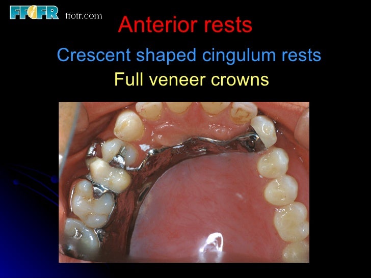 3.partial denture rests