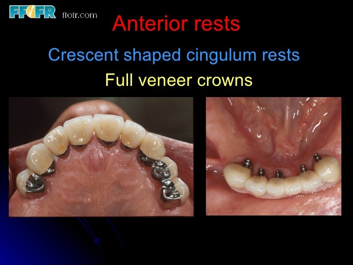 3.partial denture rests