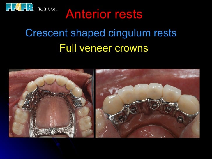 3.partial denture rests