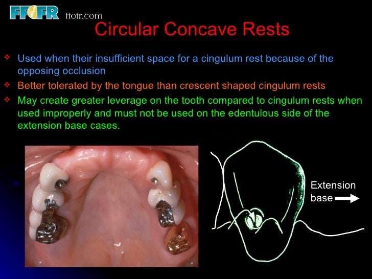 3.partial denture rests