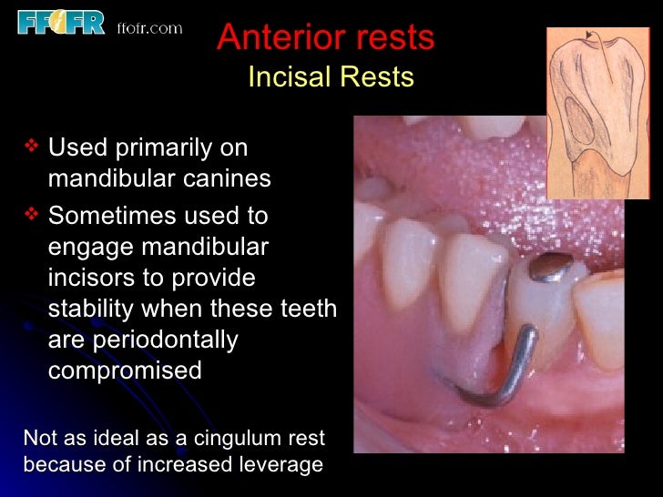 3.partial denture rests
