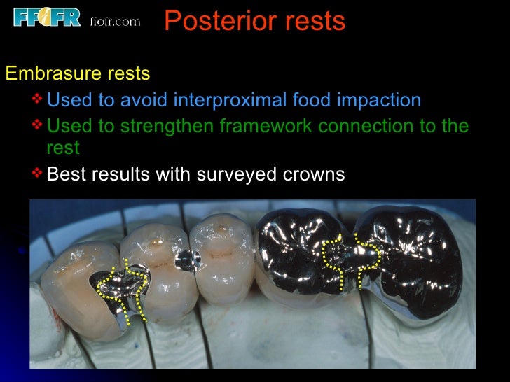 3.partial denture rests