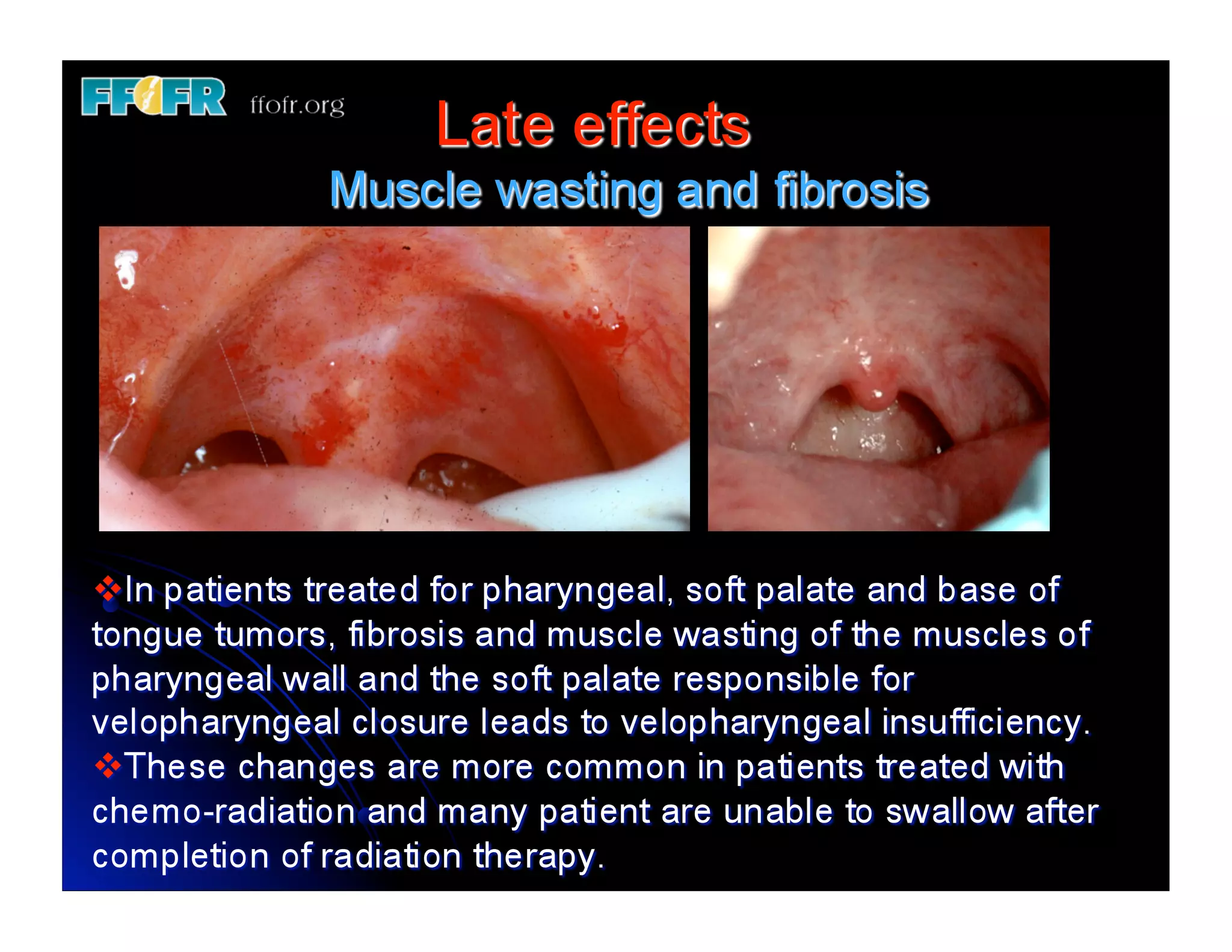 3.radiation effects mucosa, taste, jaw opening | PPT