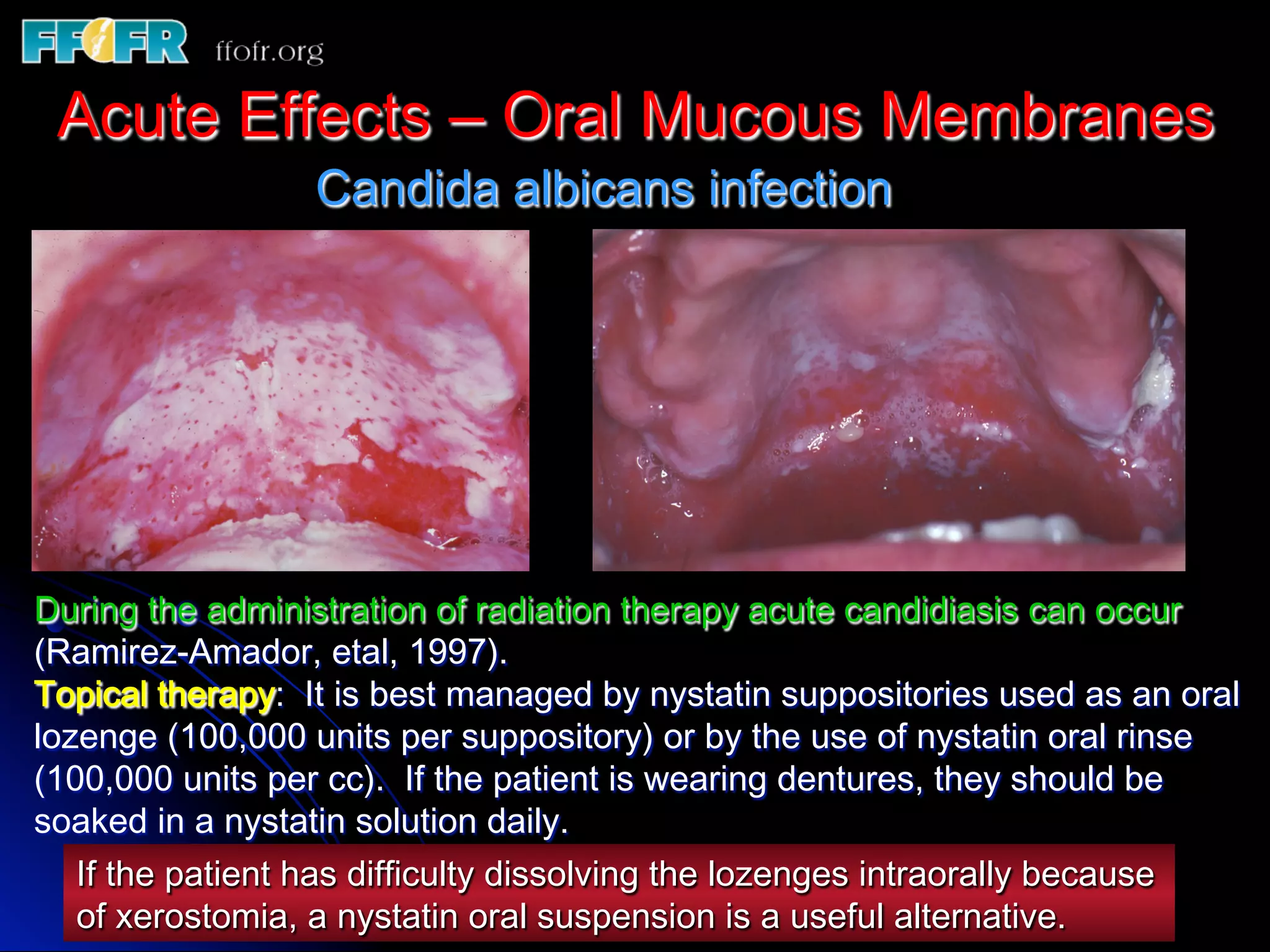 3.radiation effects mucosa, taste, jaw opening | PDF