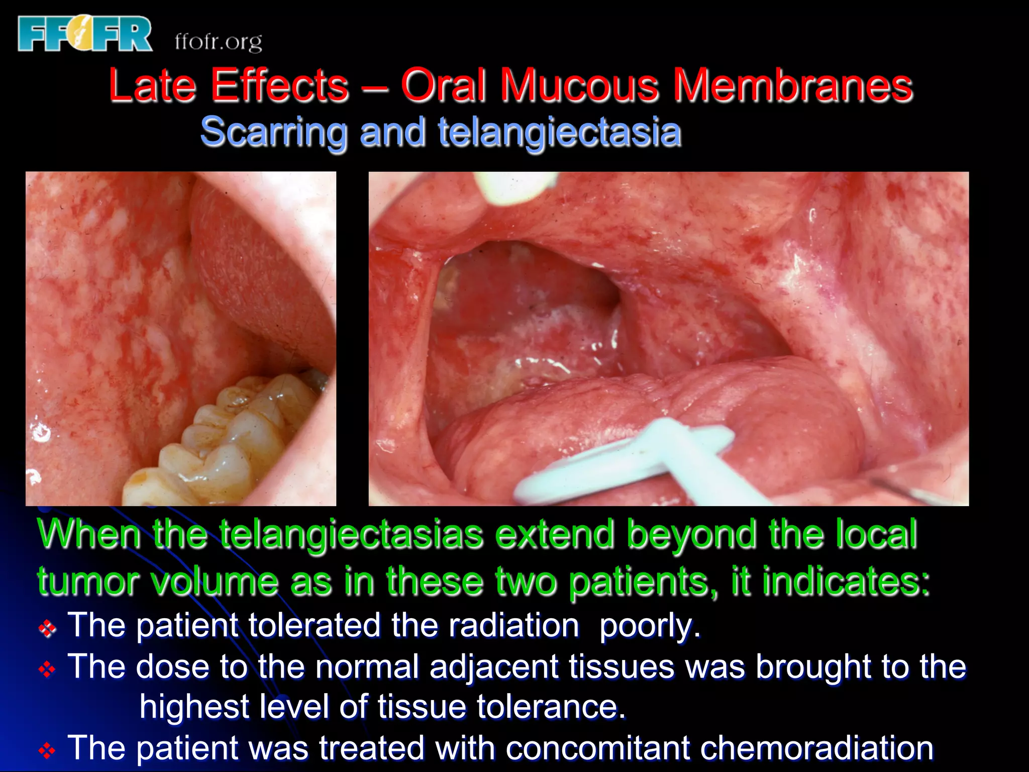 3.radiation effects mucosa, taste, jaw opening | PDF