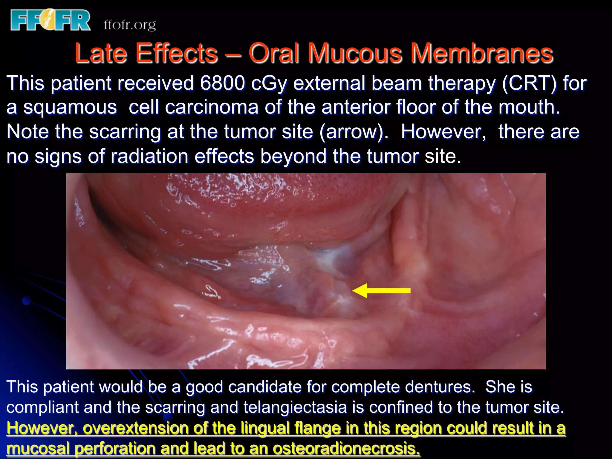 3.radiation effects mucosa, taste, jaw opening | PDF