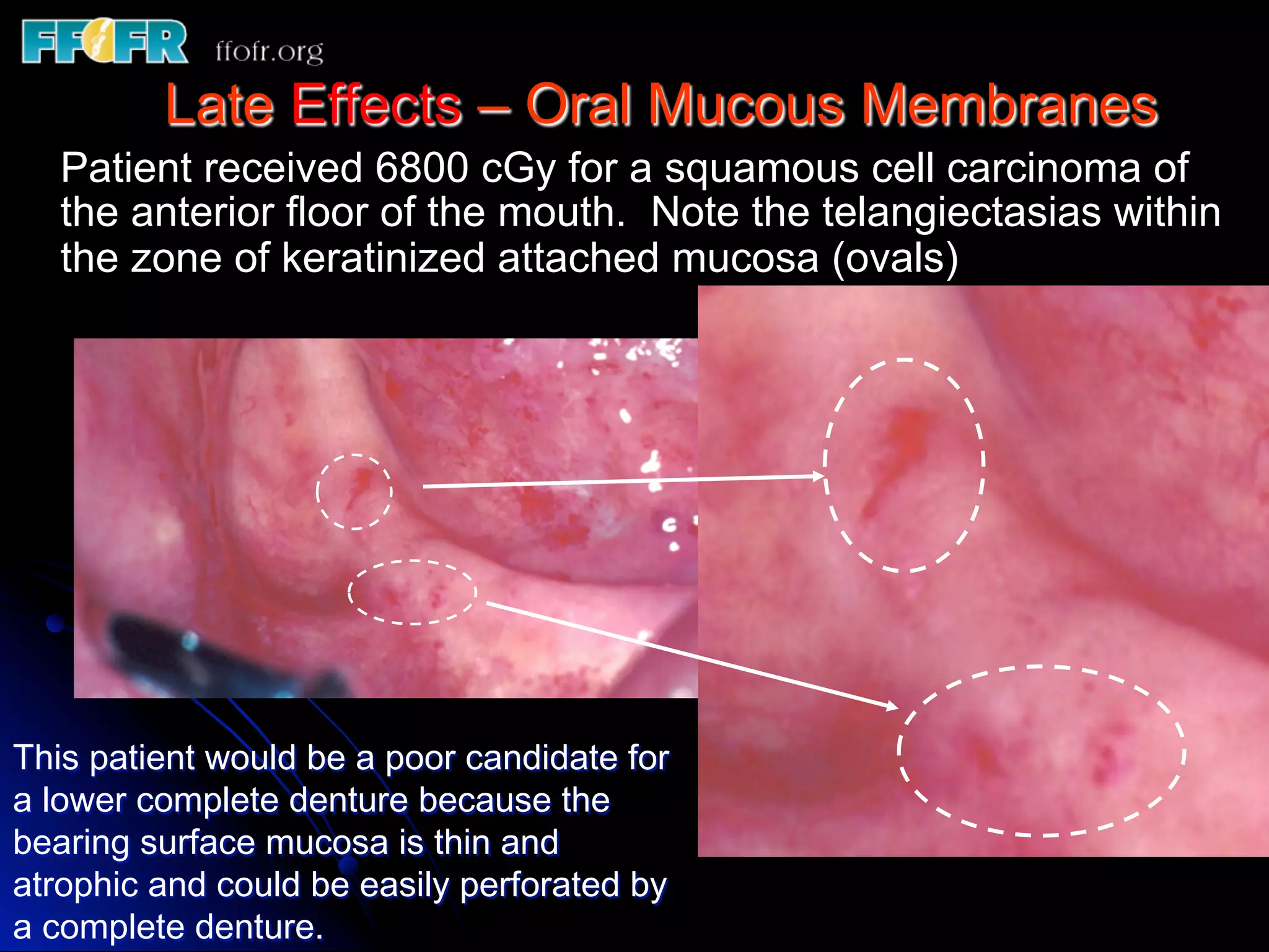 3.radiation effects mucosa, taste, jaw opening | PDF