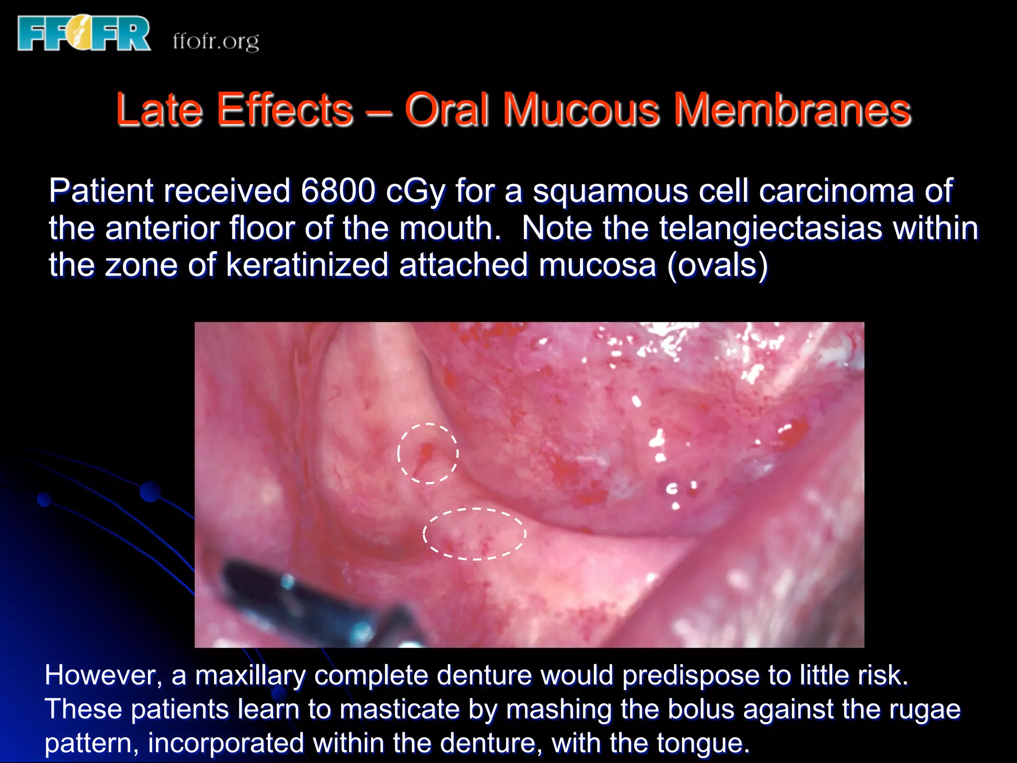 3.radiation effects mucosa, taste, jaw opening | PDF
