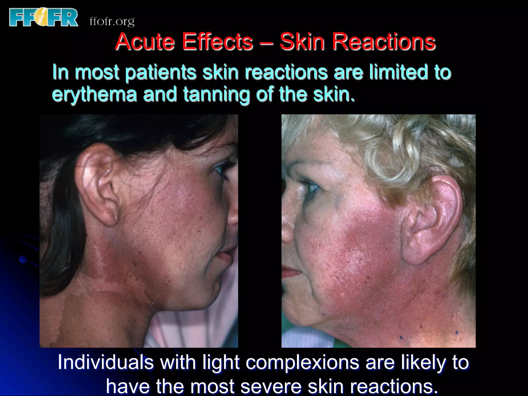 3.radiation effects mucosa, taste, jaw opening | PDF