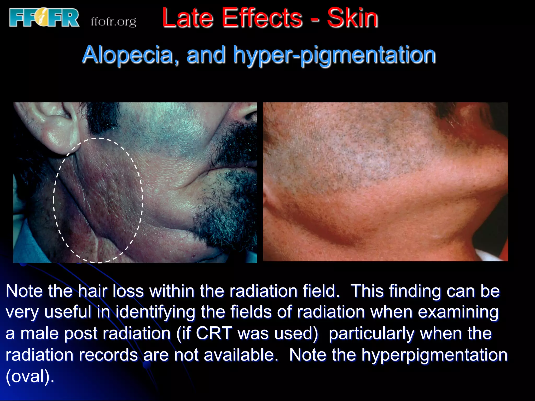3.radiation effects mucosa, taste, jaw opening | PDF