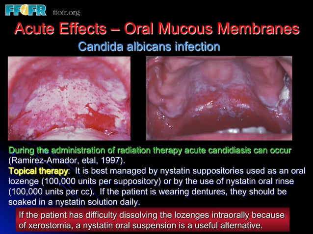 3.radiation effects mucosa, taste, jaw opening | PDF | Digestive ...