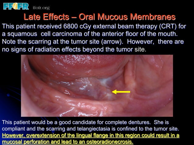 3.radiation effects mucosa, taste, jaw opening | PDF | Digestive ...