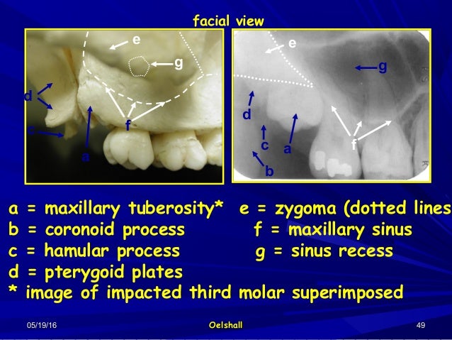 Hamular Process