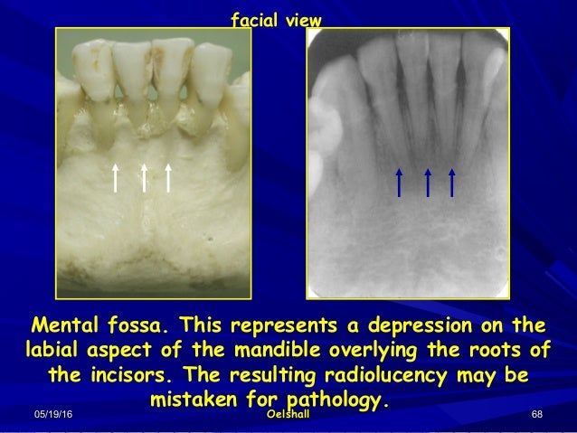 Mental Fossa Radiograph