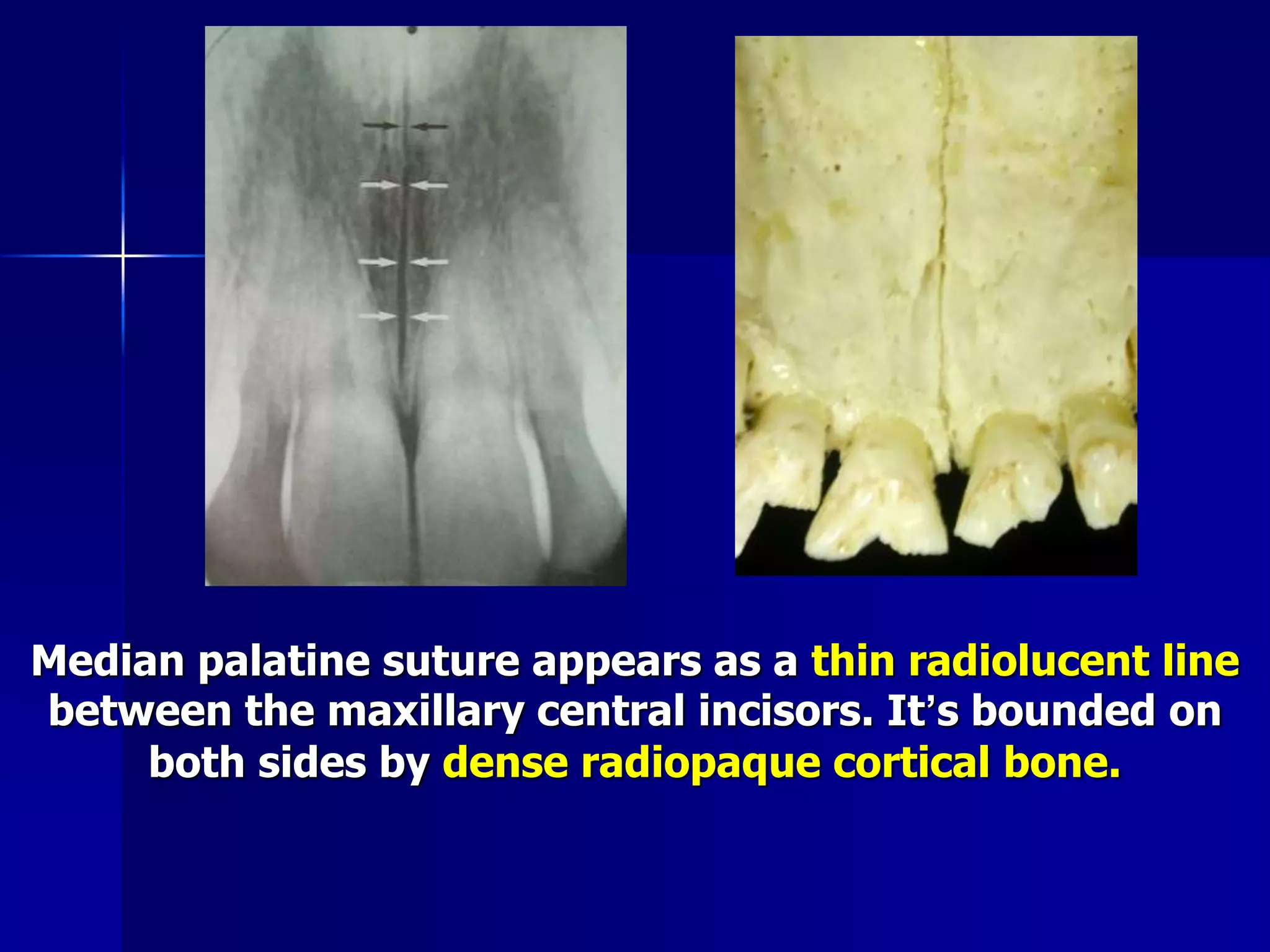 Radiographic Anatomical Landmarks | PPSX