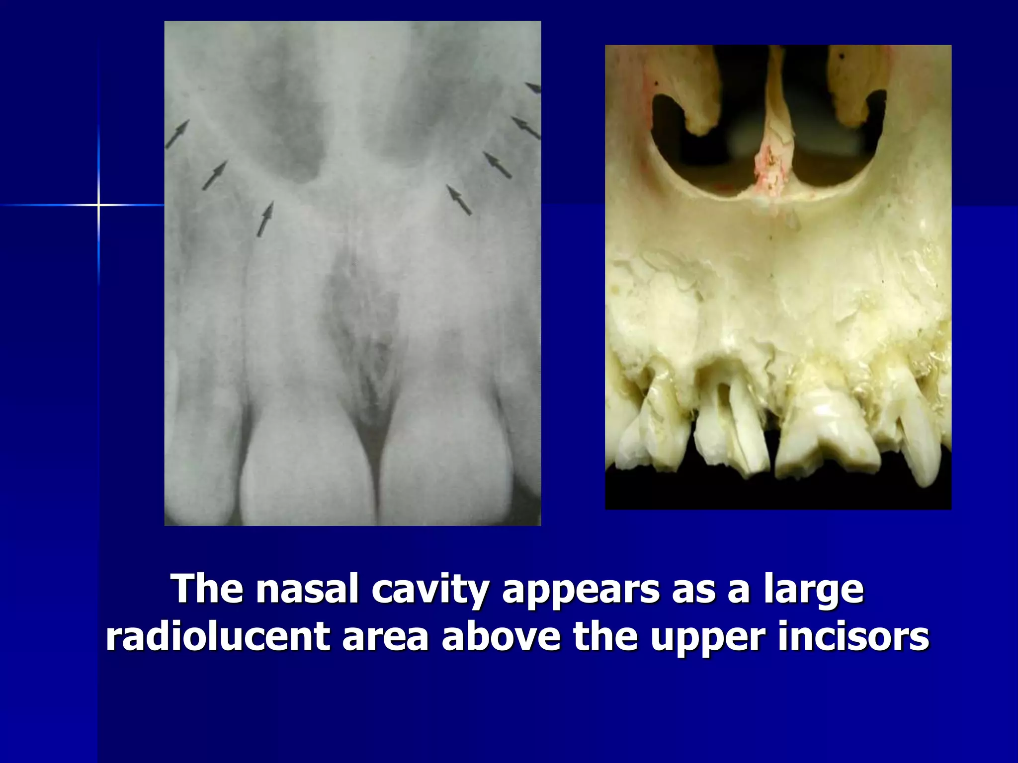 Radiographic Anatomical Landmarks | PPSX