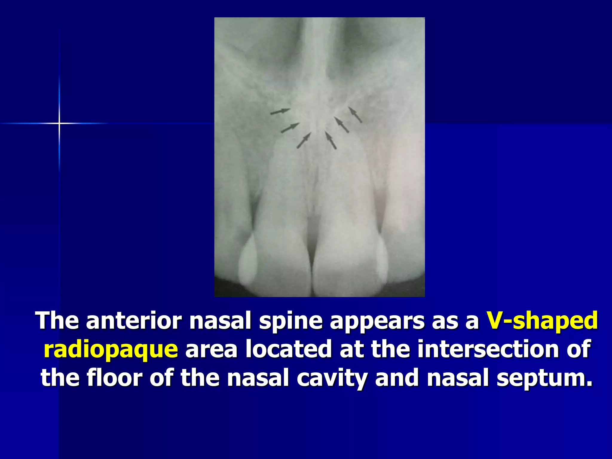 Radiographic Anatomical Landmarks | PPSX | Dental Health | Diseases and ...