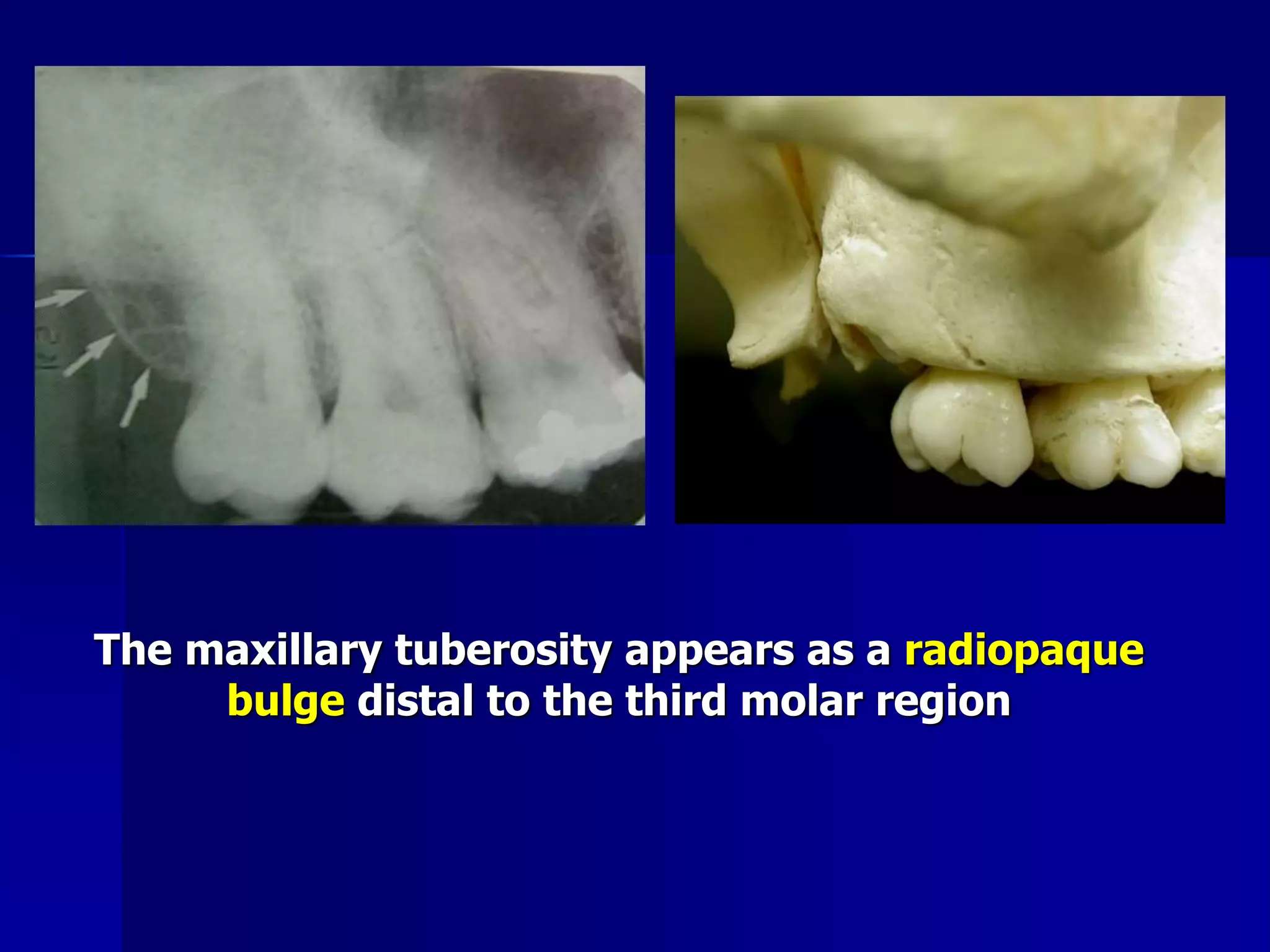 Radiographic Anatomical Landmarks | PPSX | Dental Health | Diseases and ...