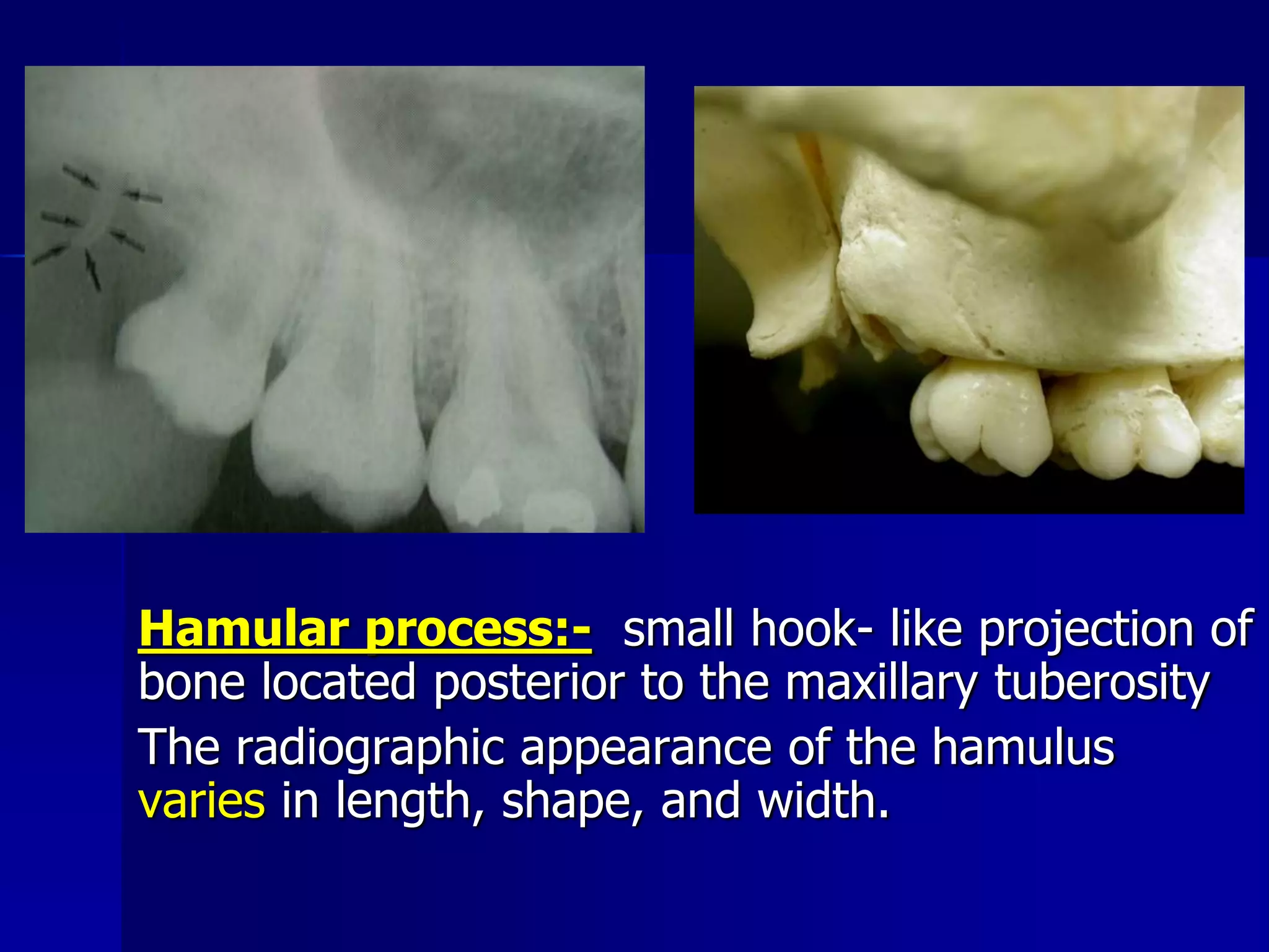 Radiographic Anatomical Landmarks | PPSX | Dental Health | Diseases and ...