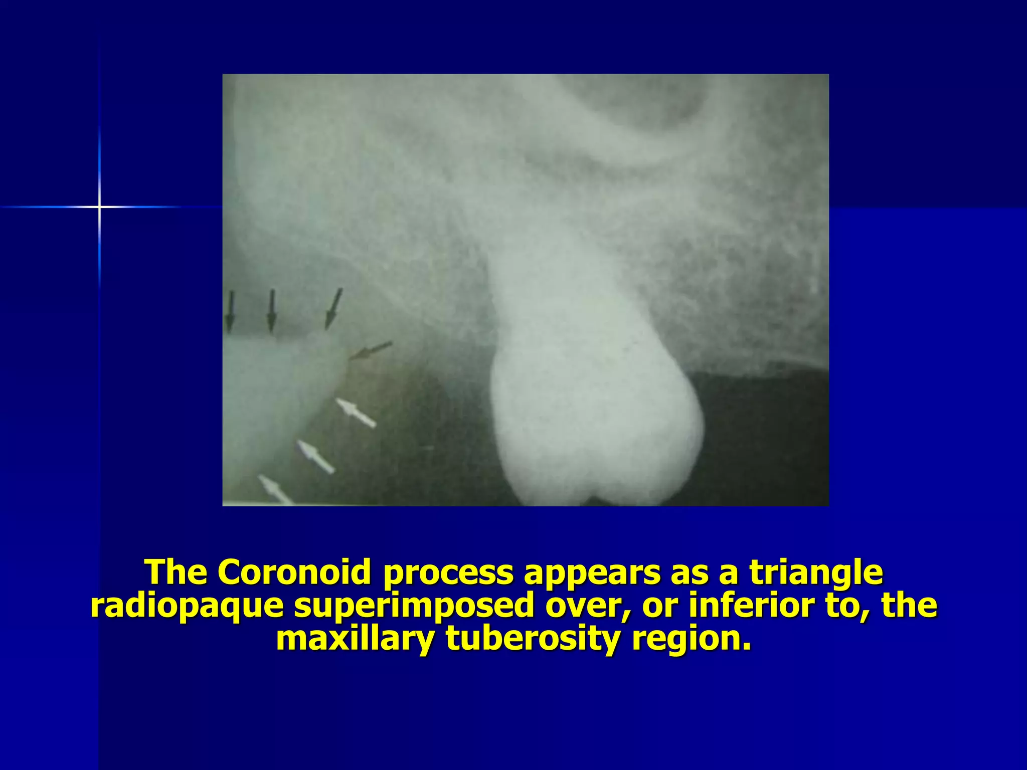 Radiographic Anatomical Landmarks | PPSX