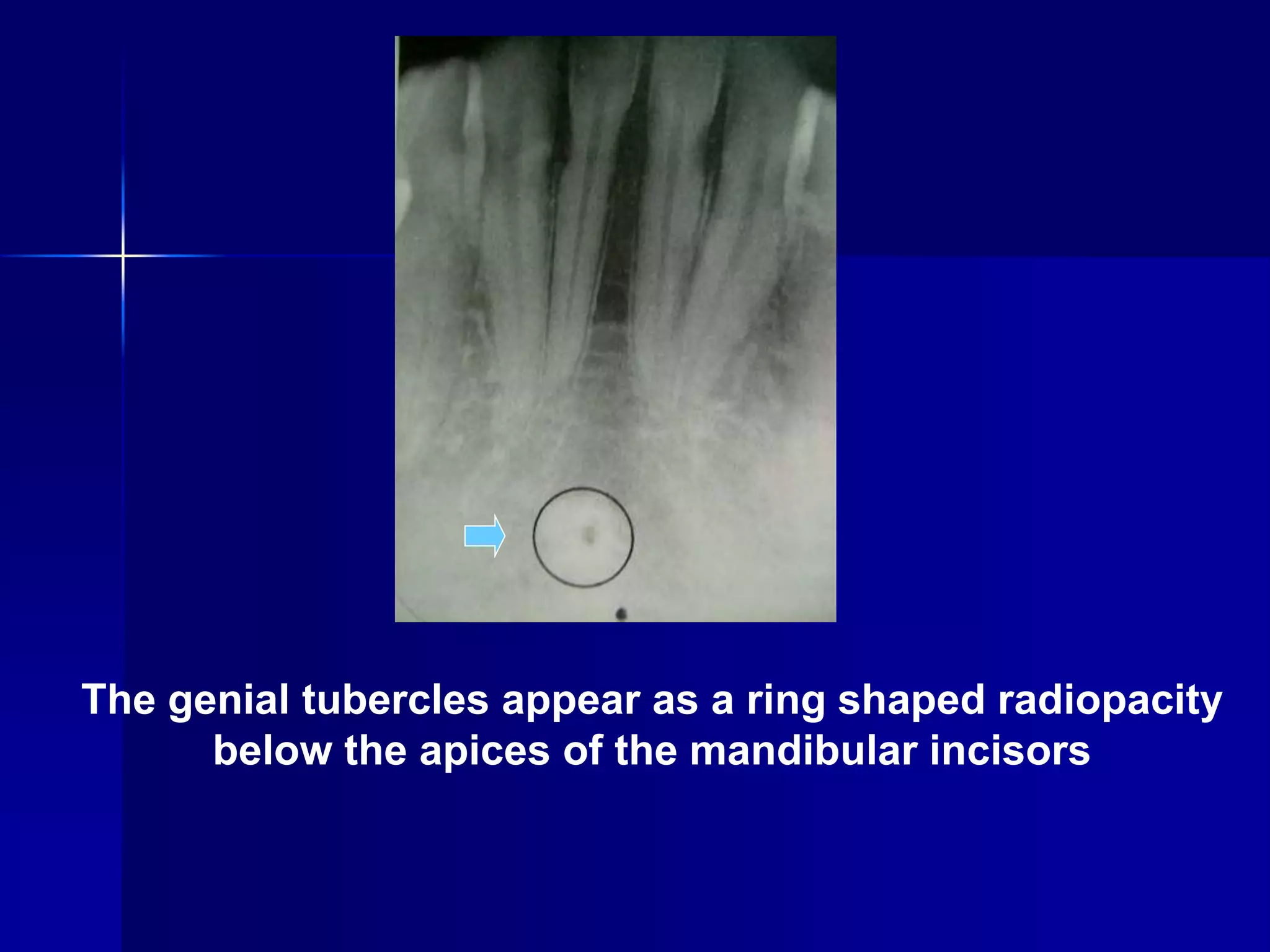Radiographic Anatomical Landmarks | PPSX