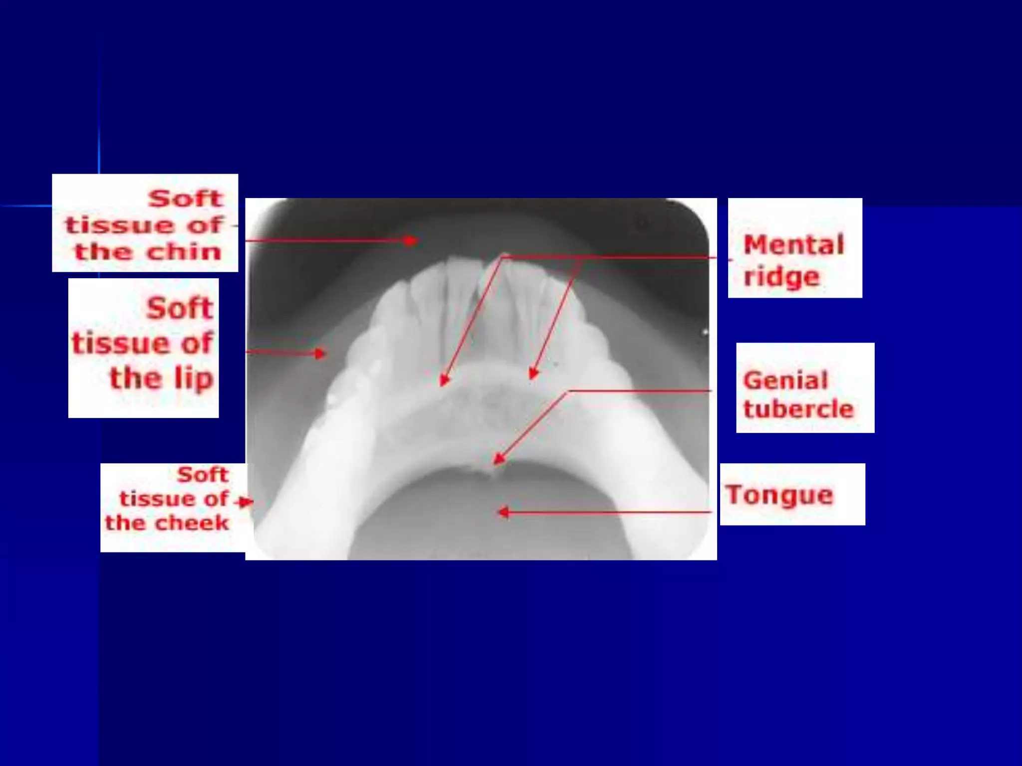 Radiographic Anatomical Landmarks | PPSX