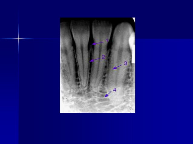 Radiographic Anatomical Landmarks | PPSX | Dental Health | Diseases and ...