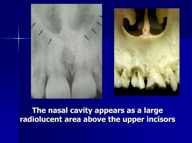 Radiographic Anatomical Landmarks | PPSX | Dental Health | Diseases and ...