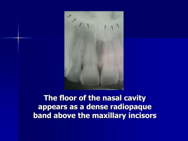 Radiographic Anatomical Landmarks | PPSX | Dental Health | Diseases and ...