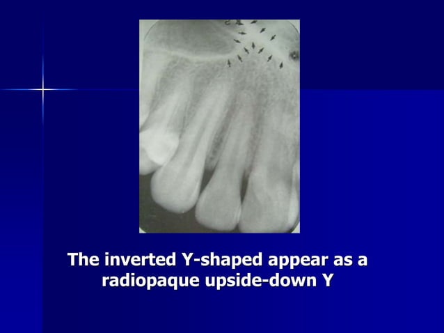 Radiographic Anatomical Landmarks | PPSX | Dental Health | Diseases and ...
