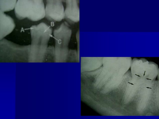 Radiographic Anatomical Landmarks | PPSX | Dental Health | Diseases and ...