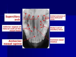 Radiographic Anatomical Landmarks | PPSX | Dental Health | Diseases and ...