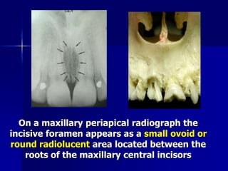 Incisive Foramen Of Maxilla