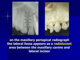 Mental Fossa Radiograph