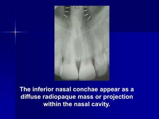 Inferior Nasal Concha Radiograph