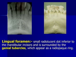 Genial Tubercles Xray