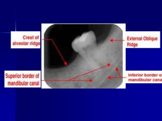 External Oblique Ridge Cbct